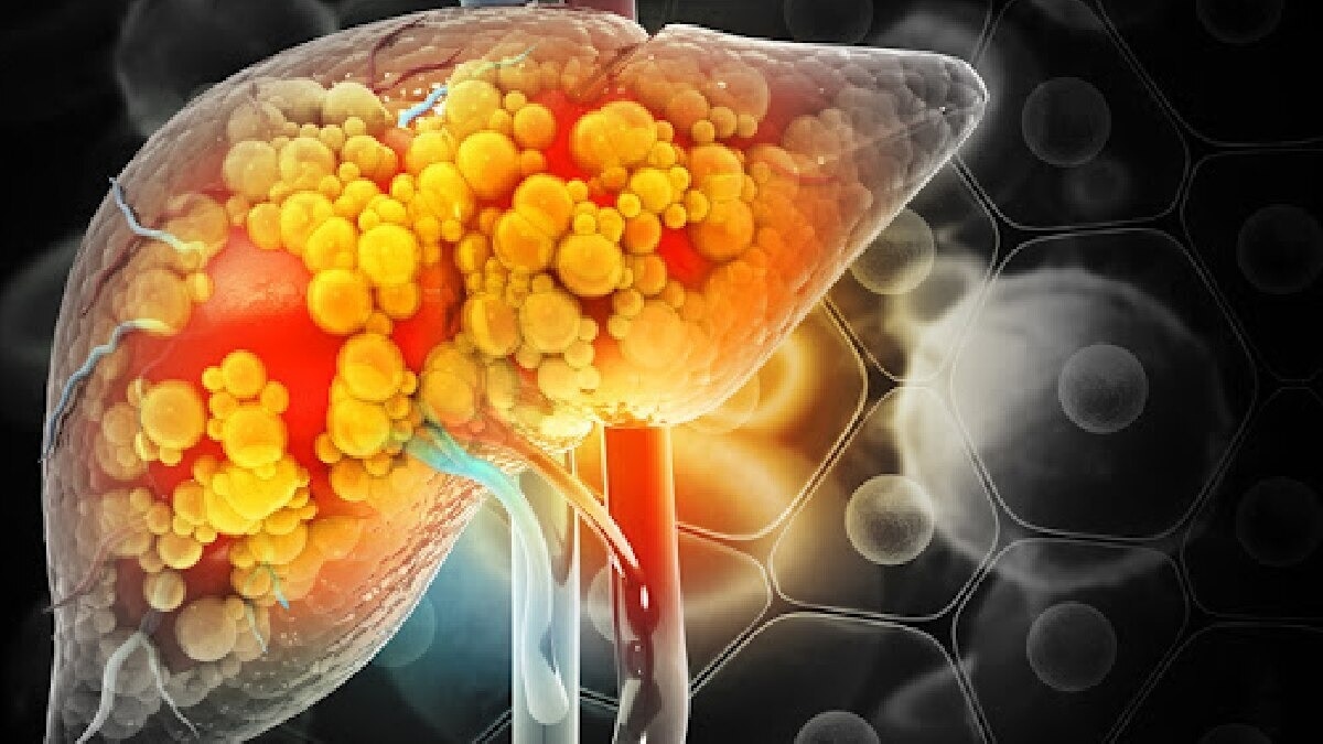 Liver function issues rise 8.9% among India Inc employees after festive ...