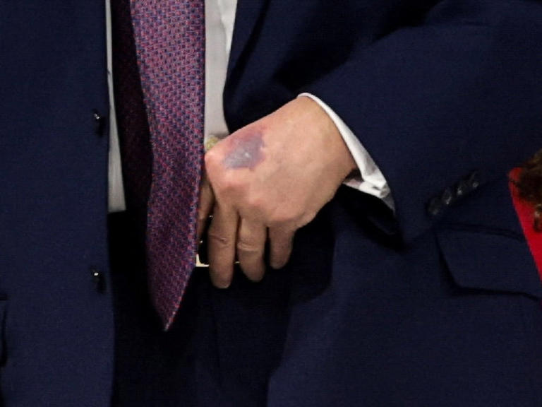 Trump's hand bruise linked to table bump