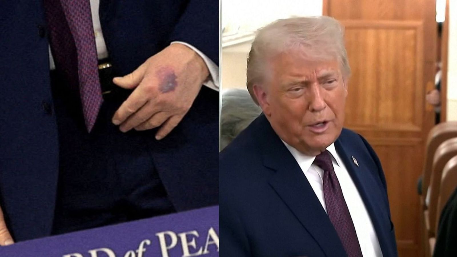 Trump comments on bruised hand