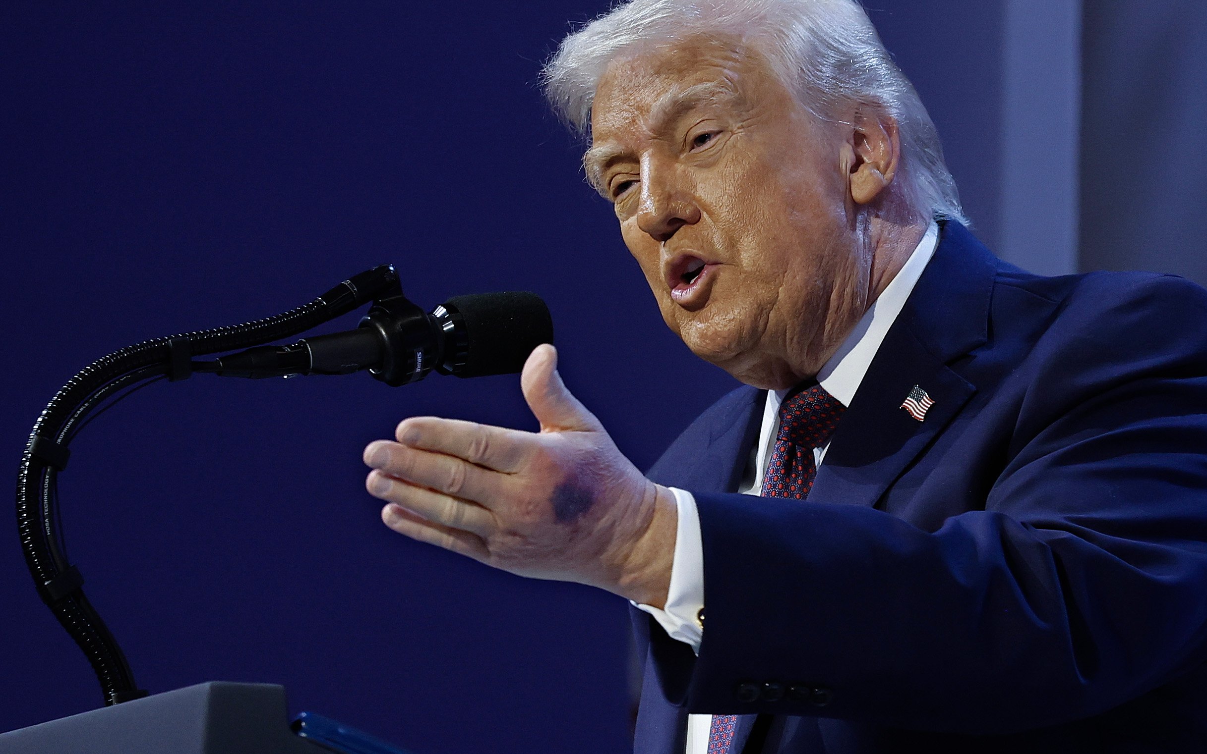 Trump's large hand bruise puts spotlight back on US president's health