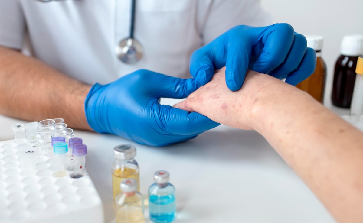 Measles is back: Why outbreaks are rising across the world again