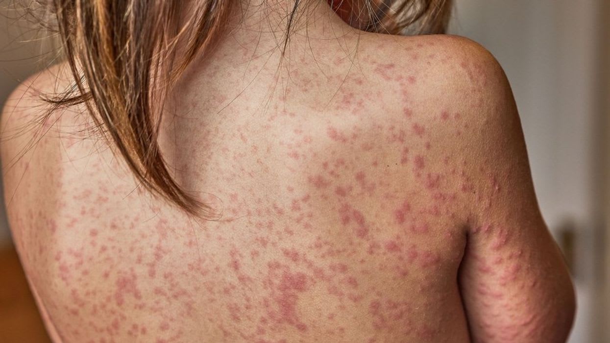 Harvard professor flabbergasted by new measles plan from admin's 'expert'
