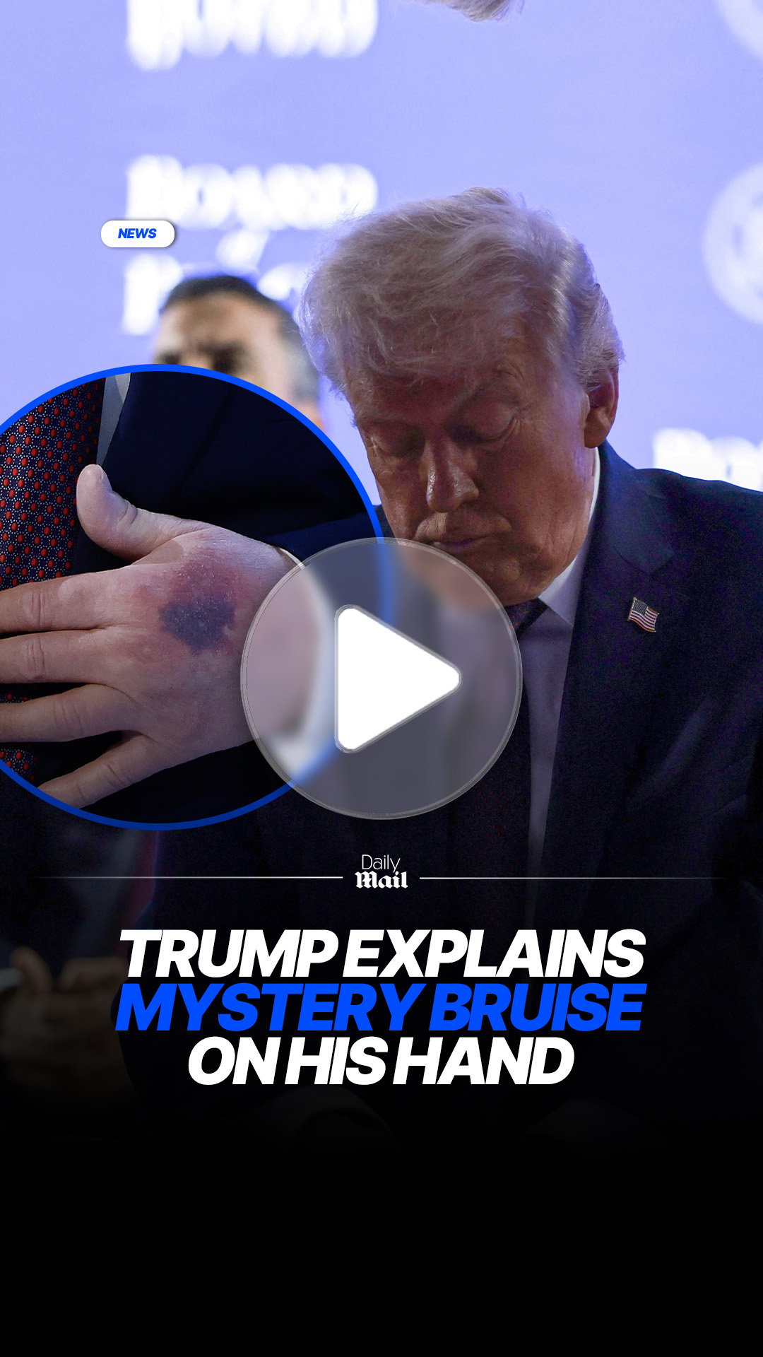 Trump explains bruise on his hand after Davos appearance