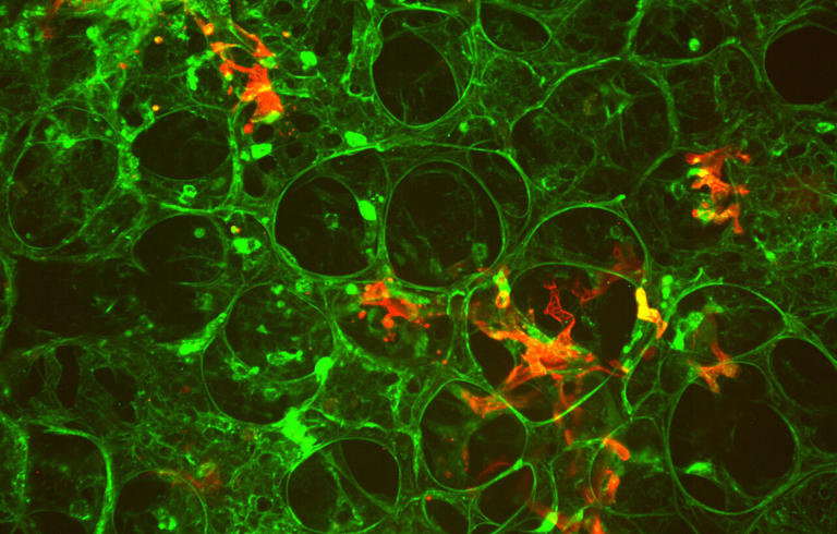 A mechanical view on metastasis: Tumor cell viscosity found to guide ...