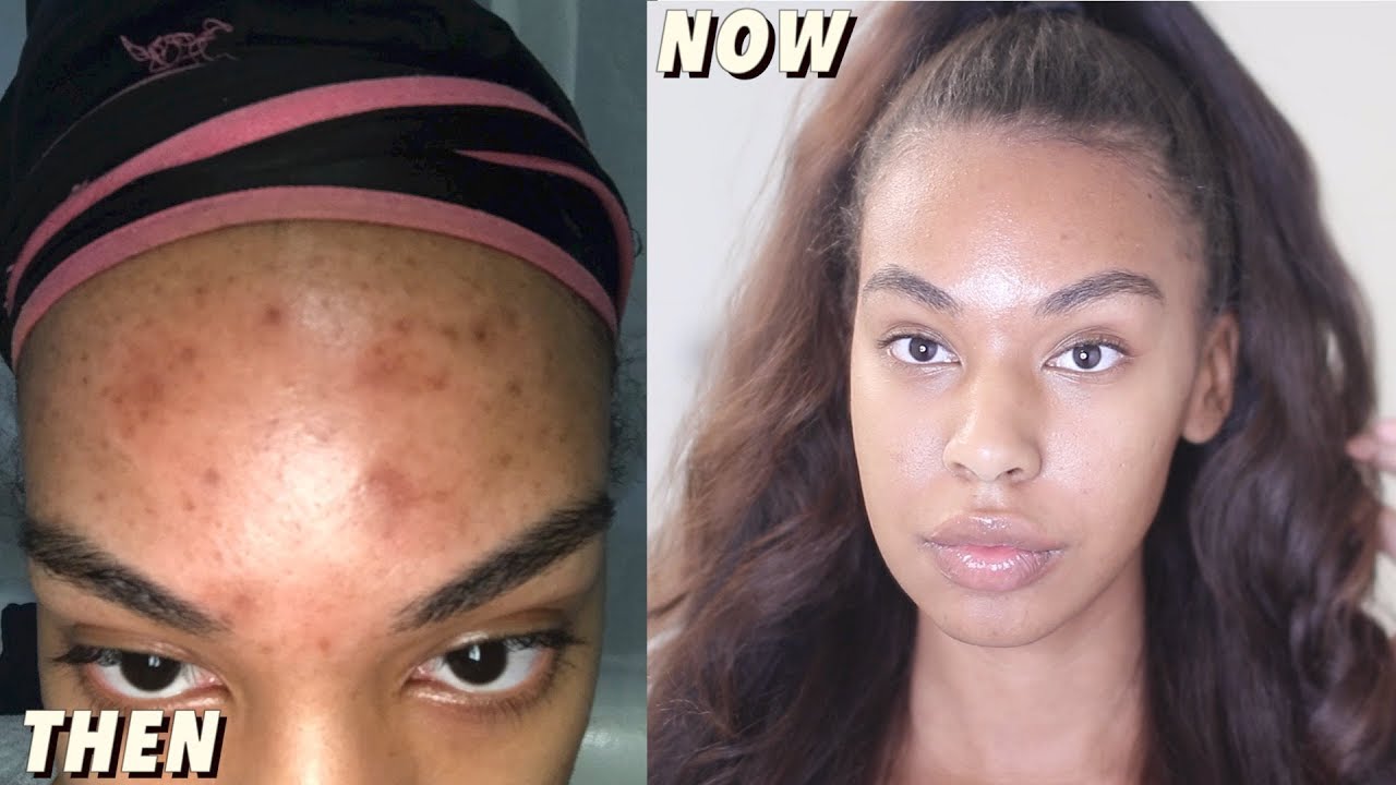 Maryam Hampton's at-home microneedling: My acne scar ...