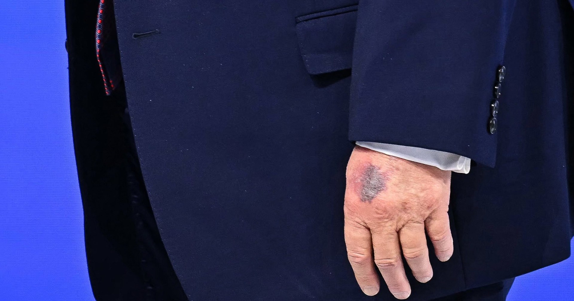 Trump explains bruised hand, says it's from aspirin