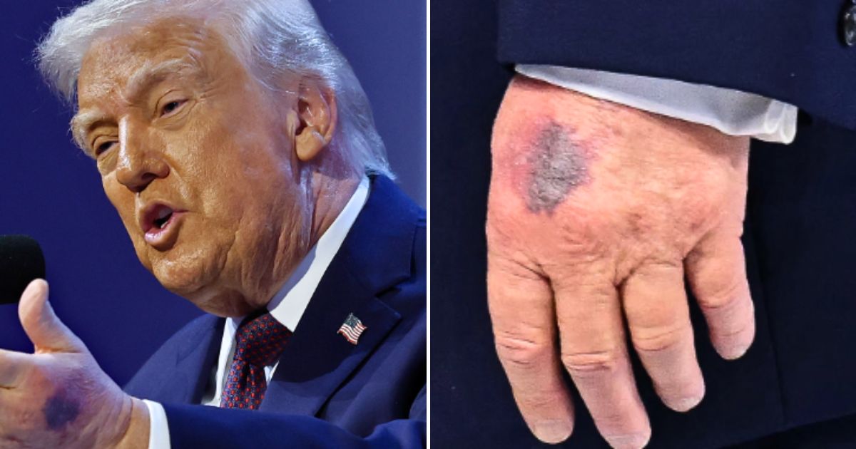 Trump’s bruised hand is back — and his latest explanation is raising ...