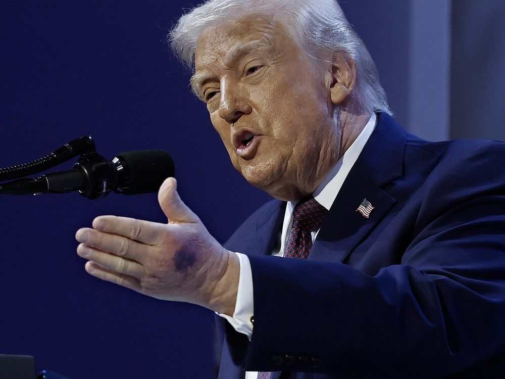 Trump says hand bruise due to bumping a table and aspirin. Is that a ...