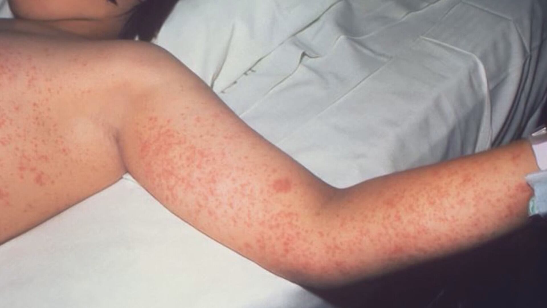 SC measles outbreak continues to grow in the Upstate