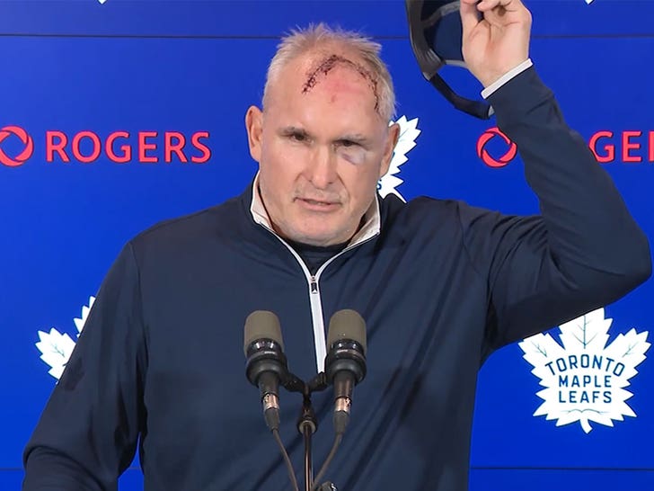 Toronto Maple Leafs coach Craig Berube reveals nasty scar from gym accident