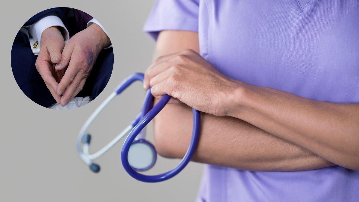 Hand bruising causes: What Trump's bruise reveals about aspirin