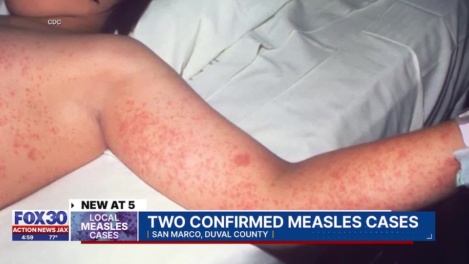 Two Duval children test positive for measles