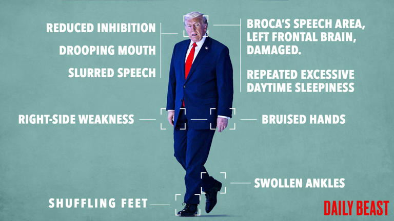 Opinion: These are the physical and mental signs Trump has had a stroke ...