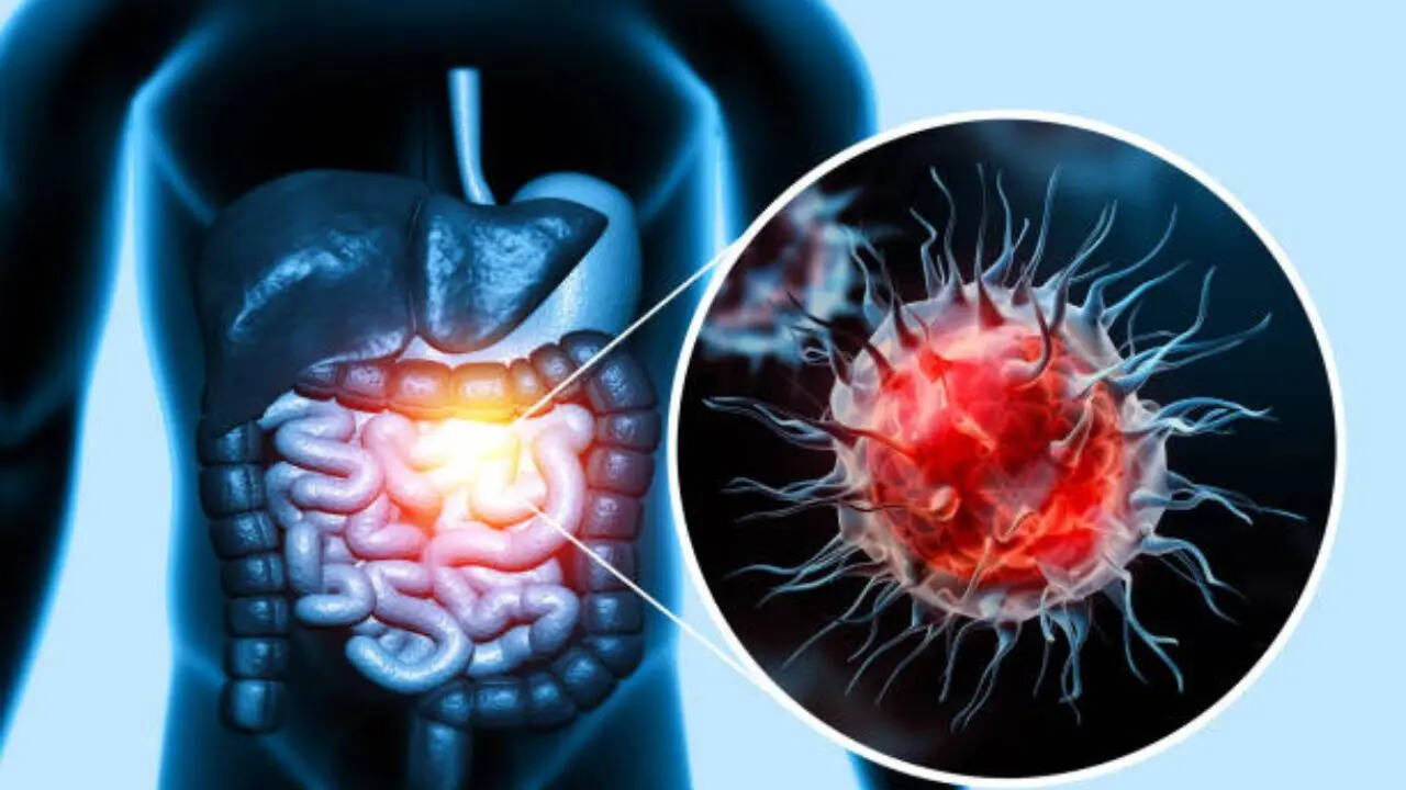 Colon cancer is now the leading cause of cancer death in people under 50