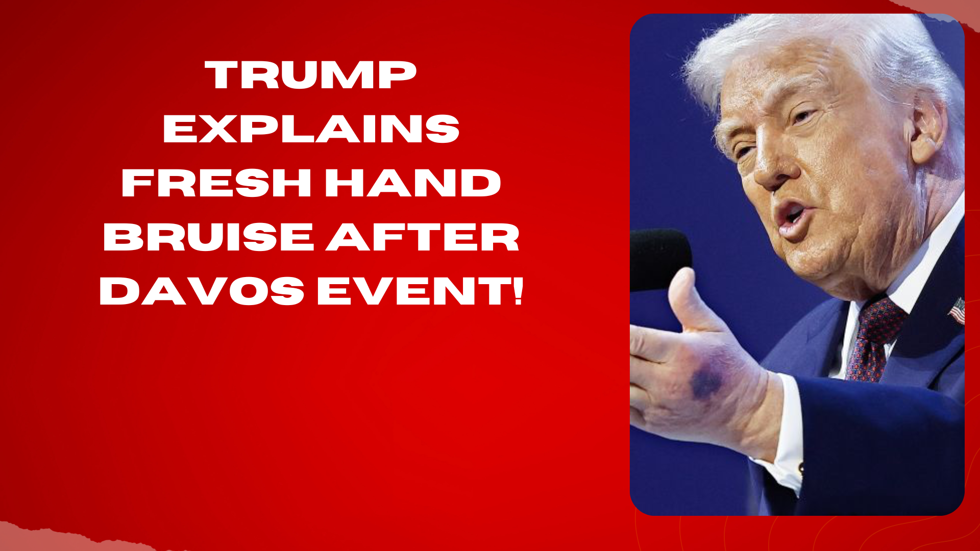 Trump explains fresh hand bruise after Davos event!