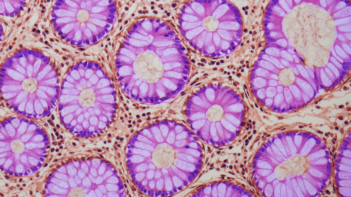 A hidden warning sign discovered in the gut may increase cancer risk