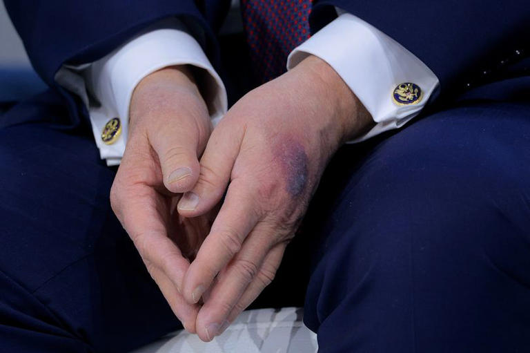 Fresh bruises appear on Donald Trump's hands during chaotic speech as ...