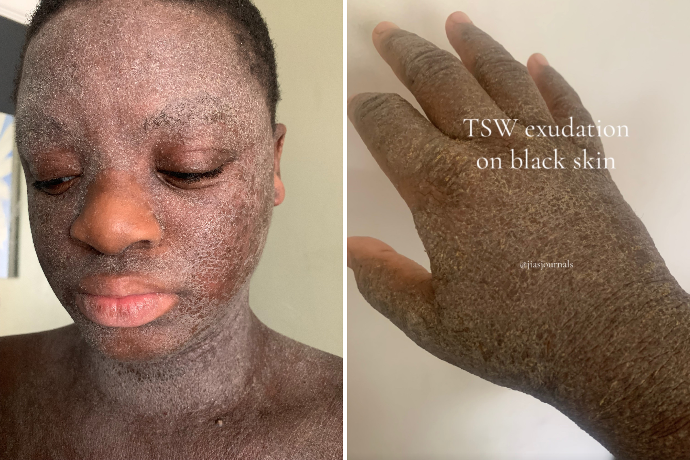 Woman given steroids as a child—now faces agonizing condition