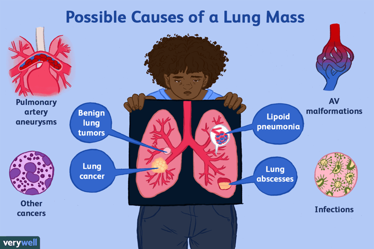 Primary lung cancer vs. metastatic vs. secondary lung cancer