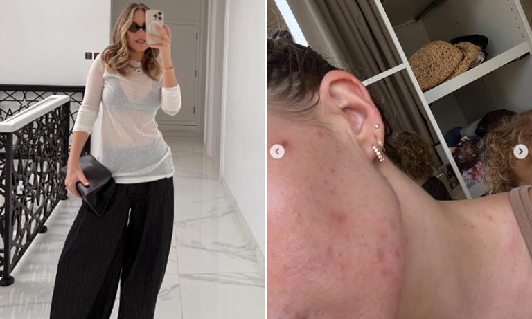 Kate Ferdinand reveals she's battling acne after feeling pressured to ...