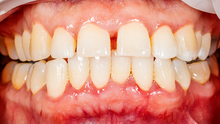 The state of your teeth could predict an early death, study shows