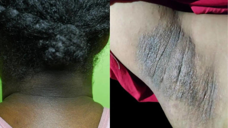 Dark, velvety patches on skin may signal insulin resistance, early ...