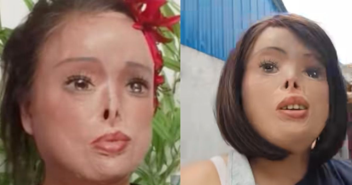 Acid attack survivor opens up about life after losing her eye to ...