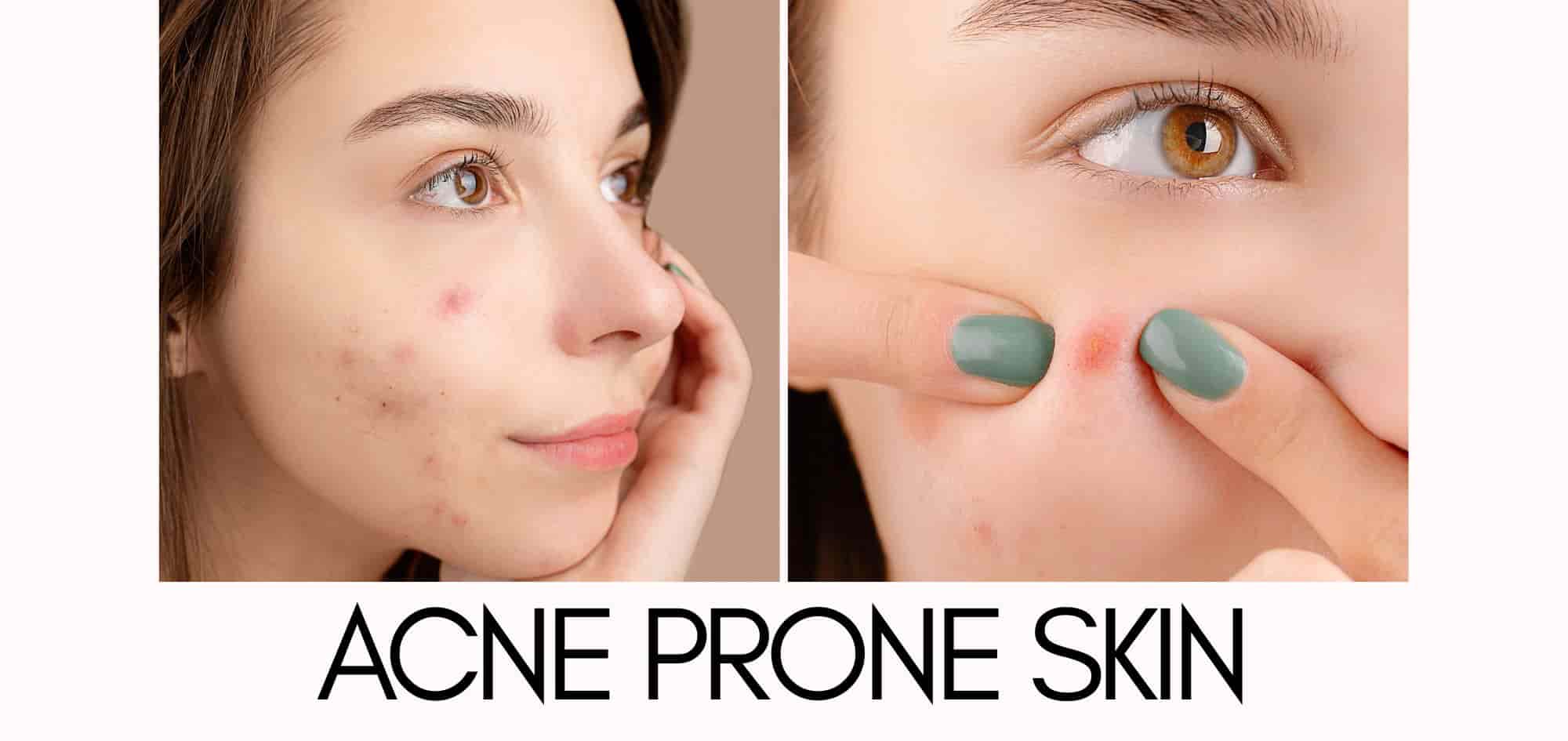 Acne prone skin: Complete care, causes and solutions