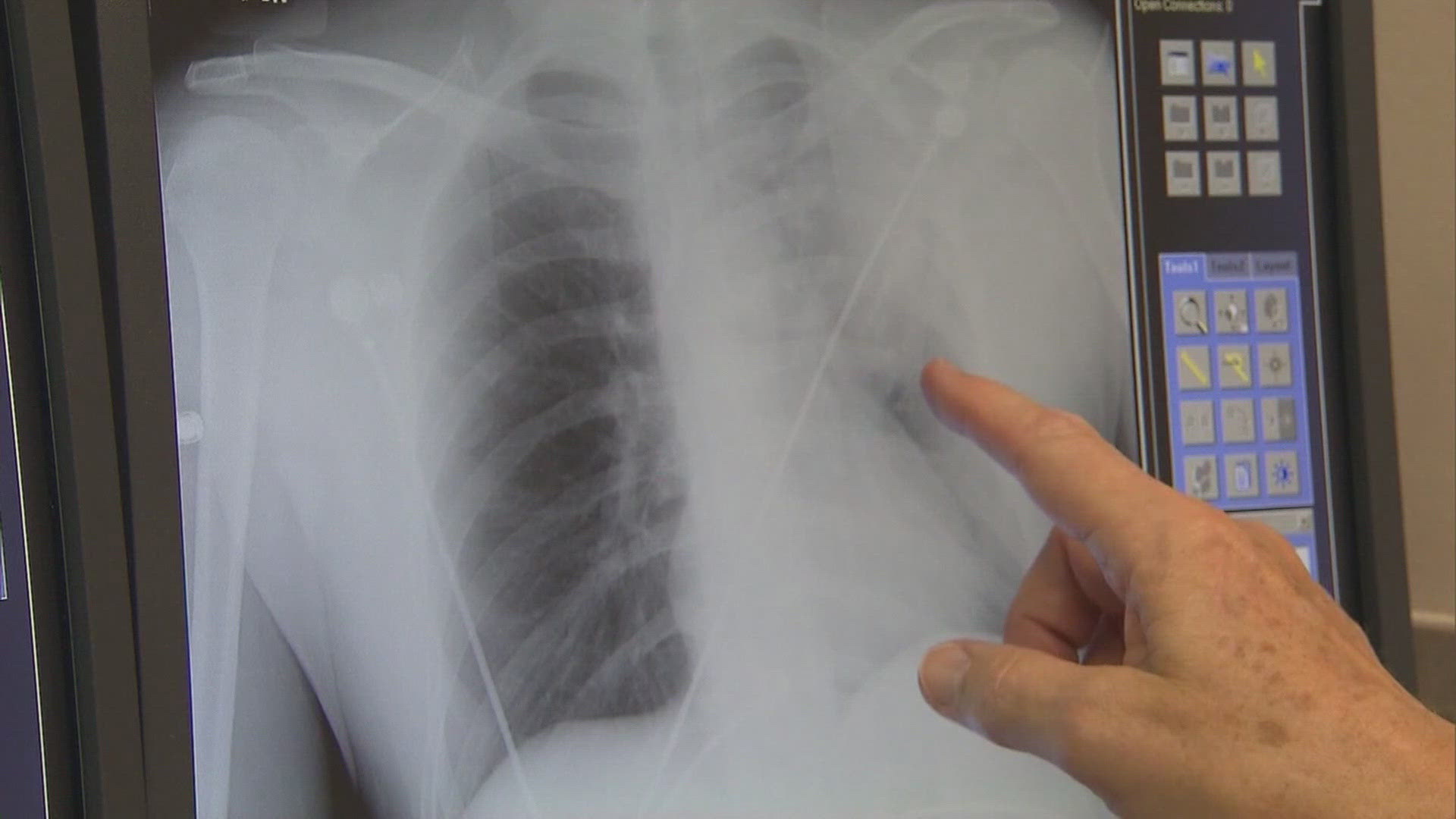 Cancer deaths drop, but cases expected to rise in 2026 | Health Minute