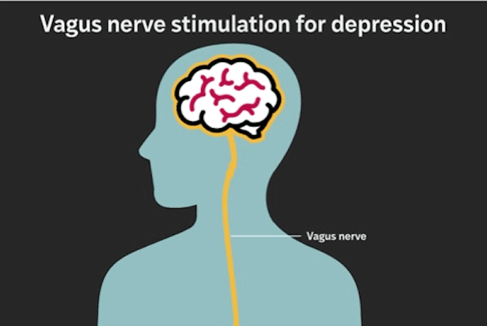 Implant provides lasting relief for treatment-resistant depression ...