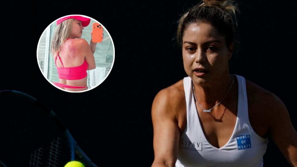 Renata Zarazúa termina su participación en Hobart y muestra quemaduras ...