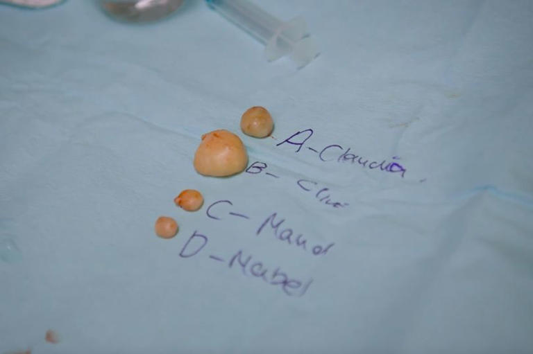 Watch moment man undergoes surgery to sever huge, bulbous cysts on his head