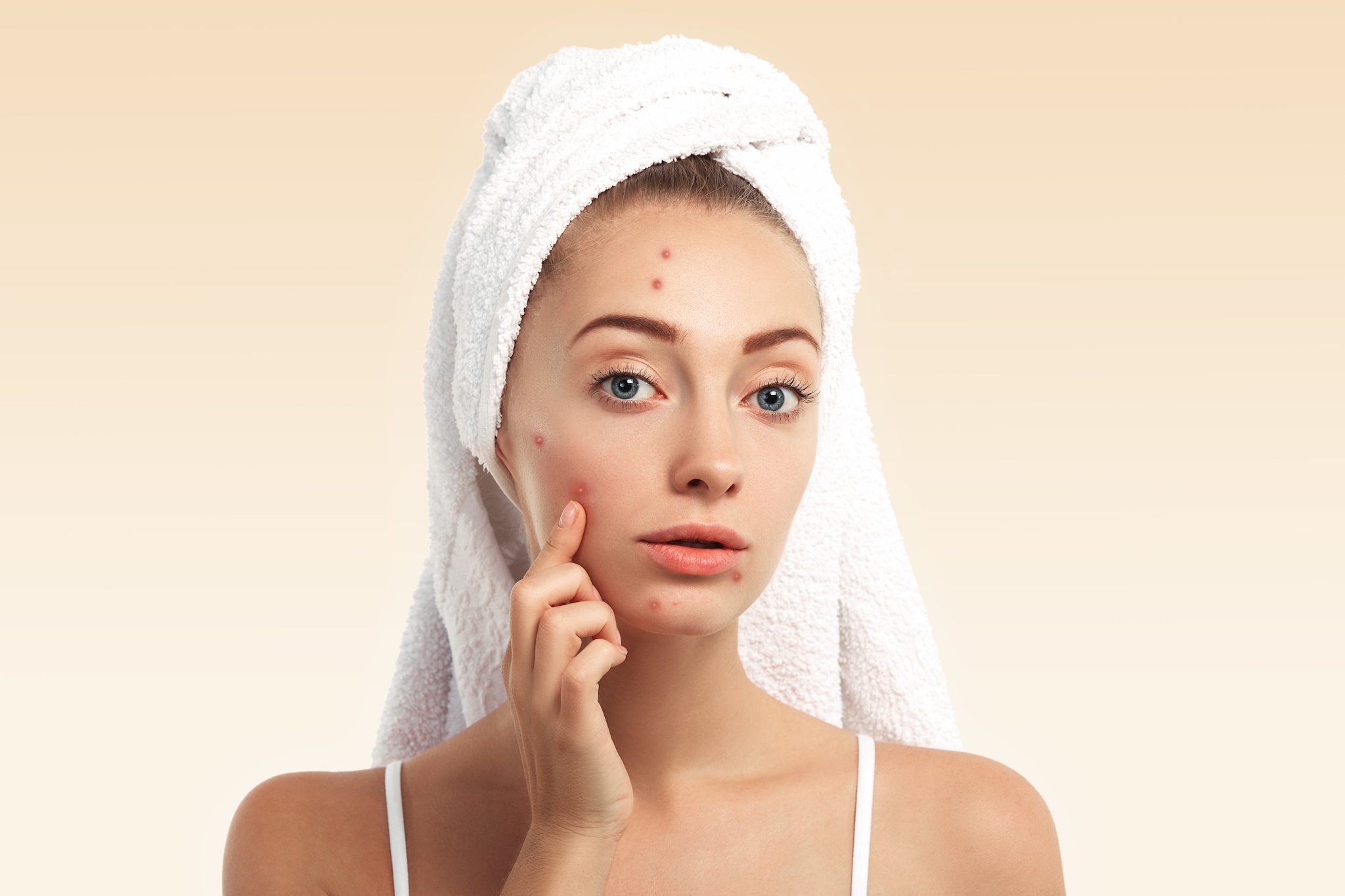 Acne prone skin: Complete care, causes and solutions