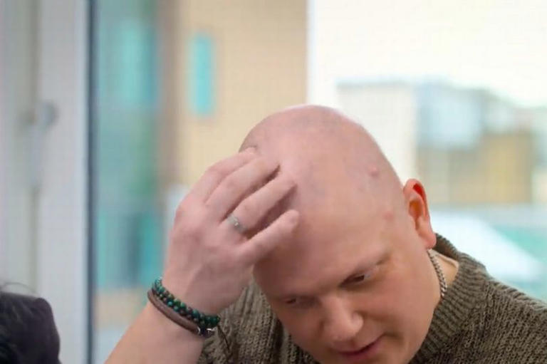 Watch moment man undergoes surgery to sever huge, bulbous cysts on his head