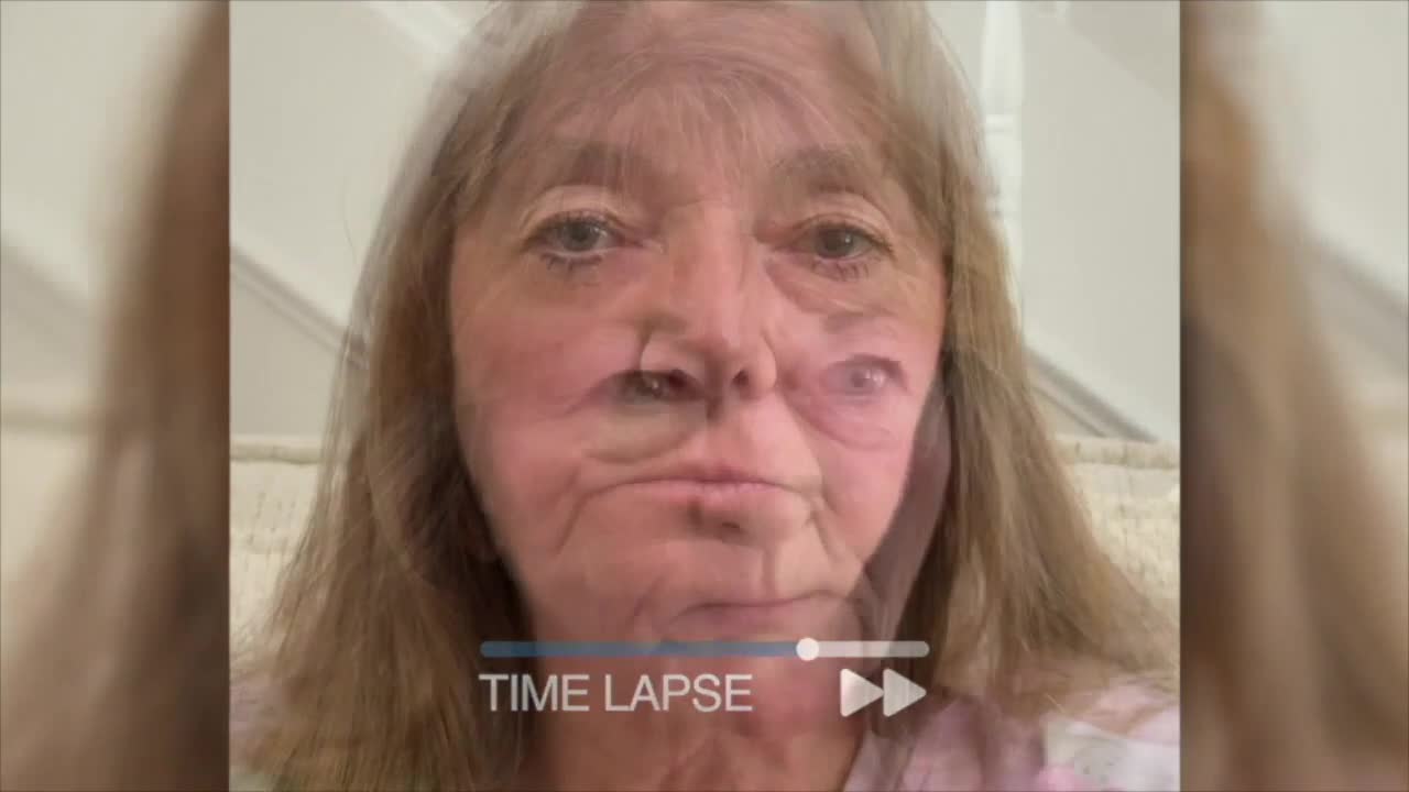 Remove undereye bags, crow's feet, and more with Plexaderm (sponsored)