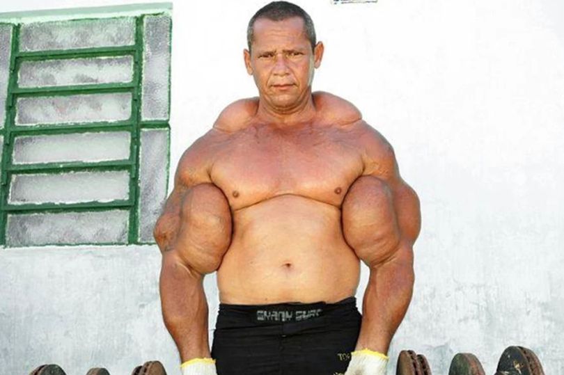 'Real-life Popeye' who boasted of growing huge arms from oil injections ...