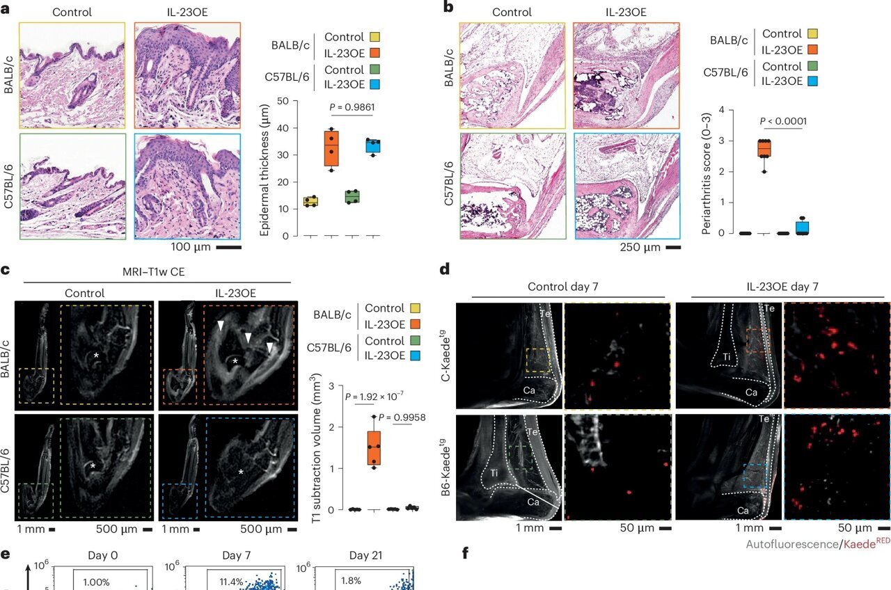 How psoriasis affects joints: Researchers discover how inflammatory ...