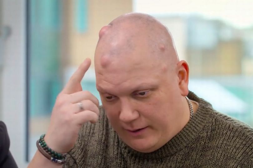 Watch moment man undergoes surgery to sever huge, bulbous cysts on his head