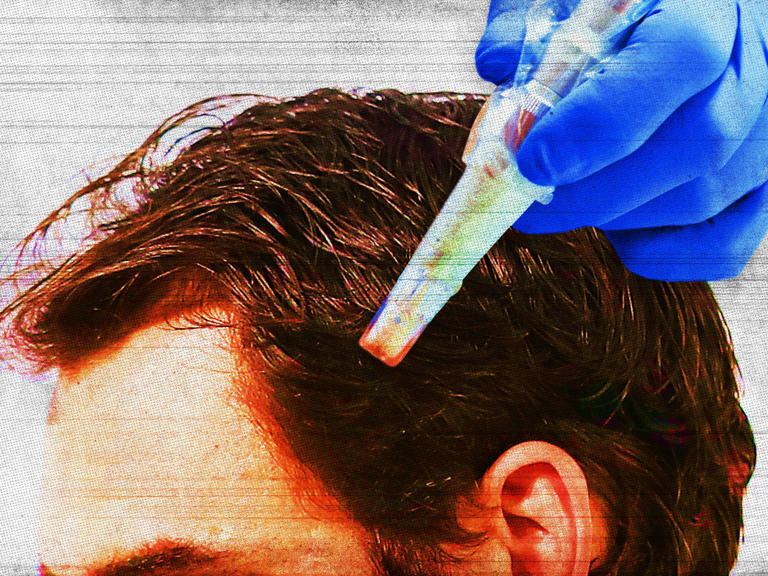 What is microneedling and does it really prevent hair loss?