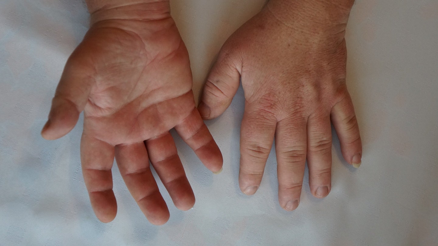 Marea reports positive phase I results for MAR002 trial in acromegaly