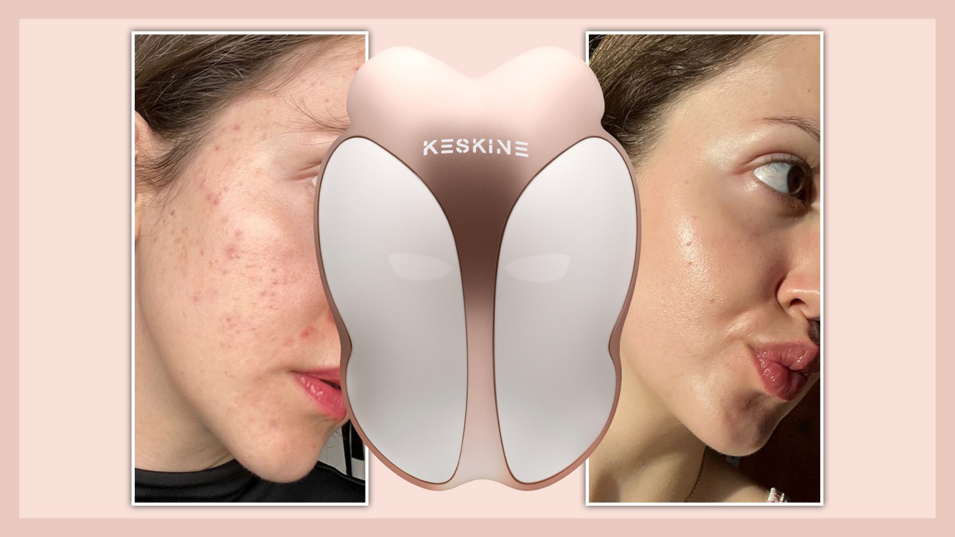 Get 80% off the Keskine LED mask for glowing skin!