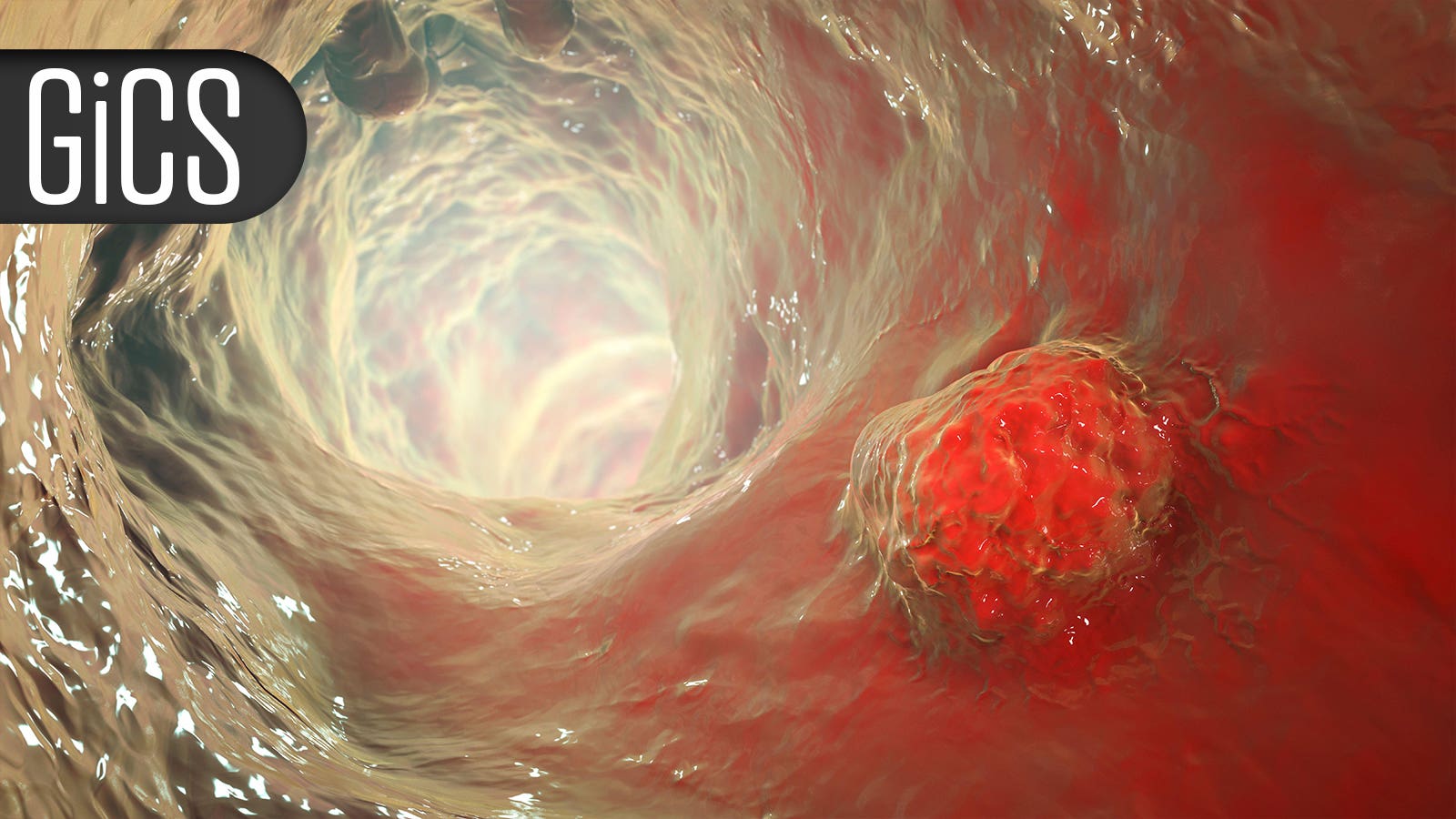 GLP-1 drugs tied to mortality reduction in colon cancer patients with ...