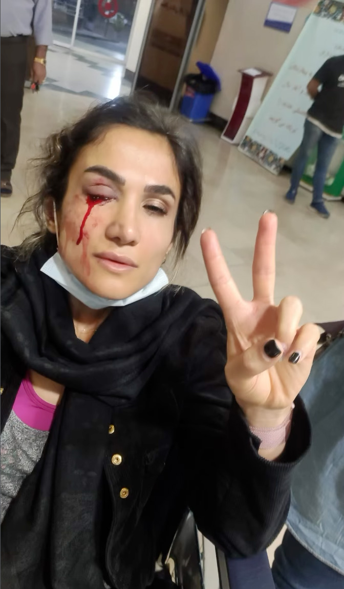 Iranian mom who lost eye to bullet in 2021 hijab protest now lives in ...