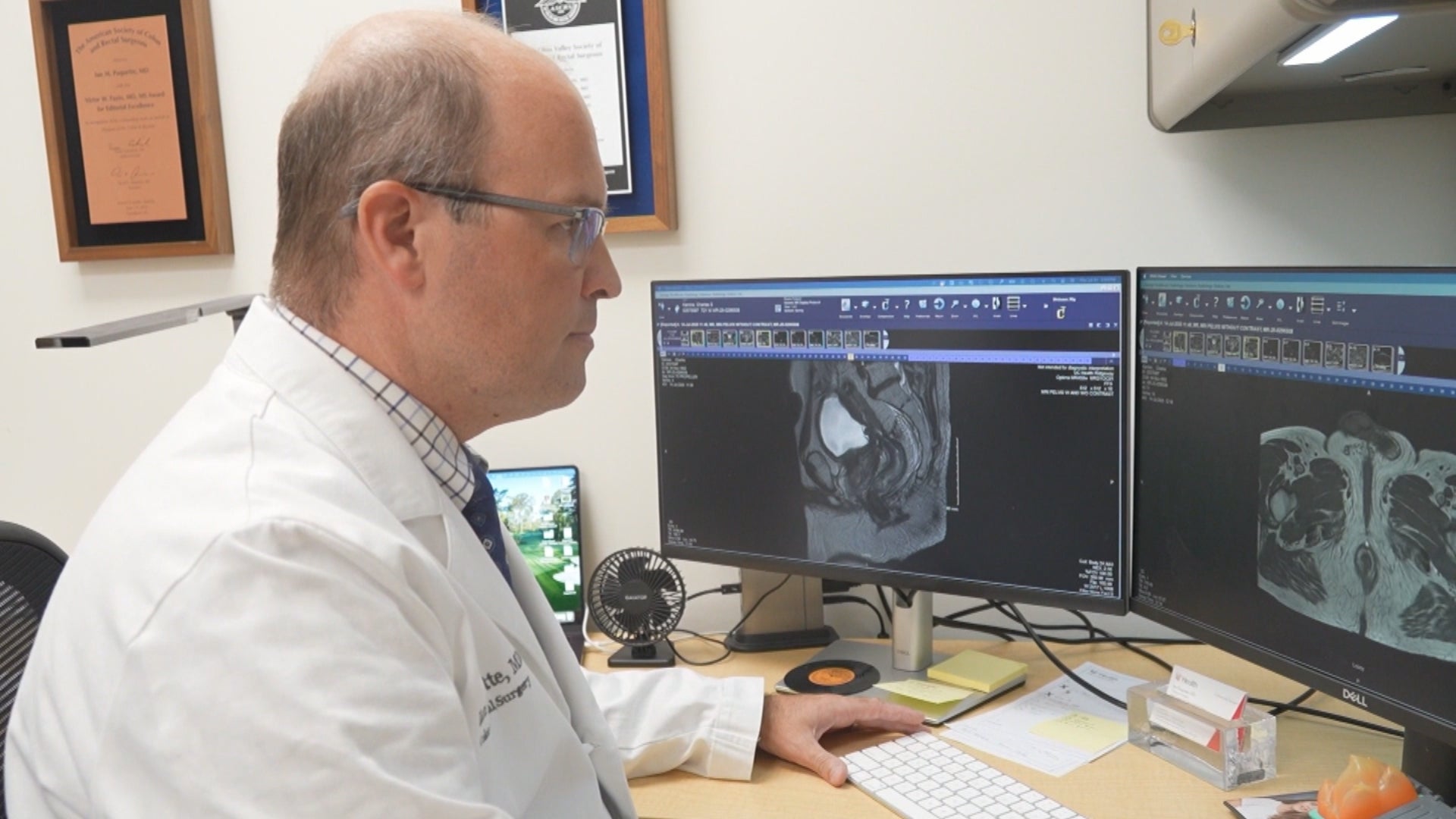 Rising rectal cancer cases in young adults prompt new treatment approach