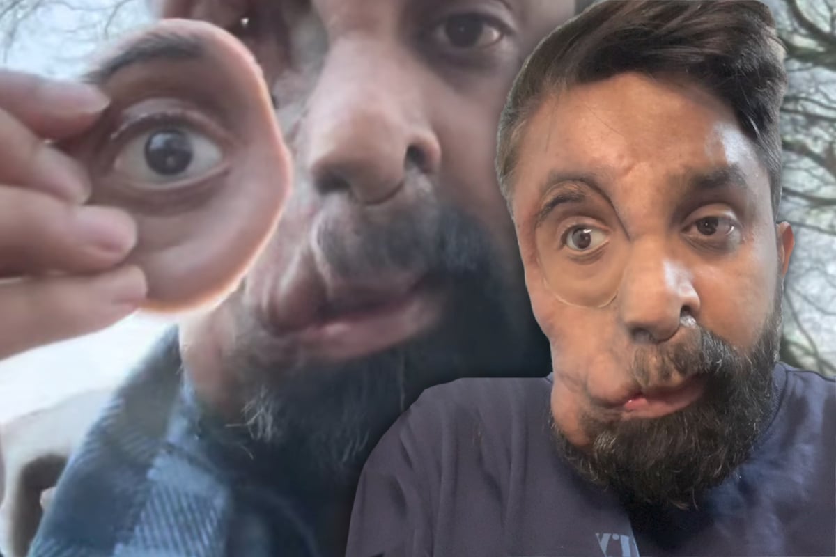 Leute fragen ihn, ob er eine Grusel-Maske trägt: Darum sieht dieser ...