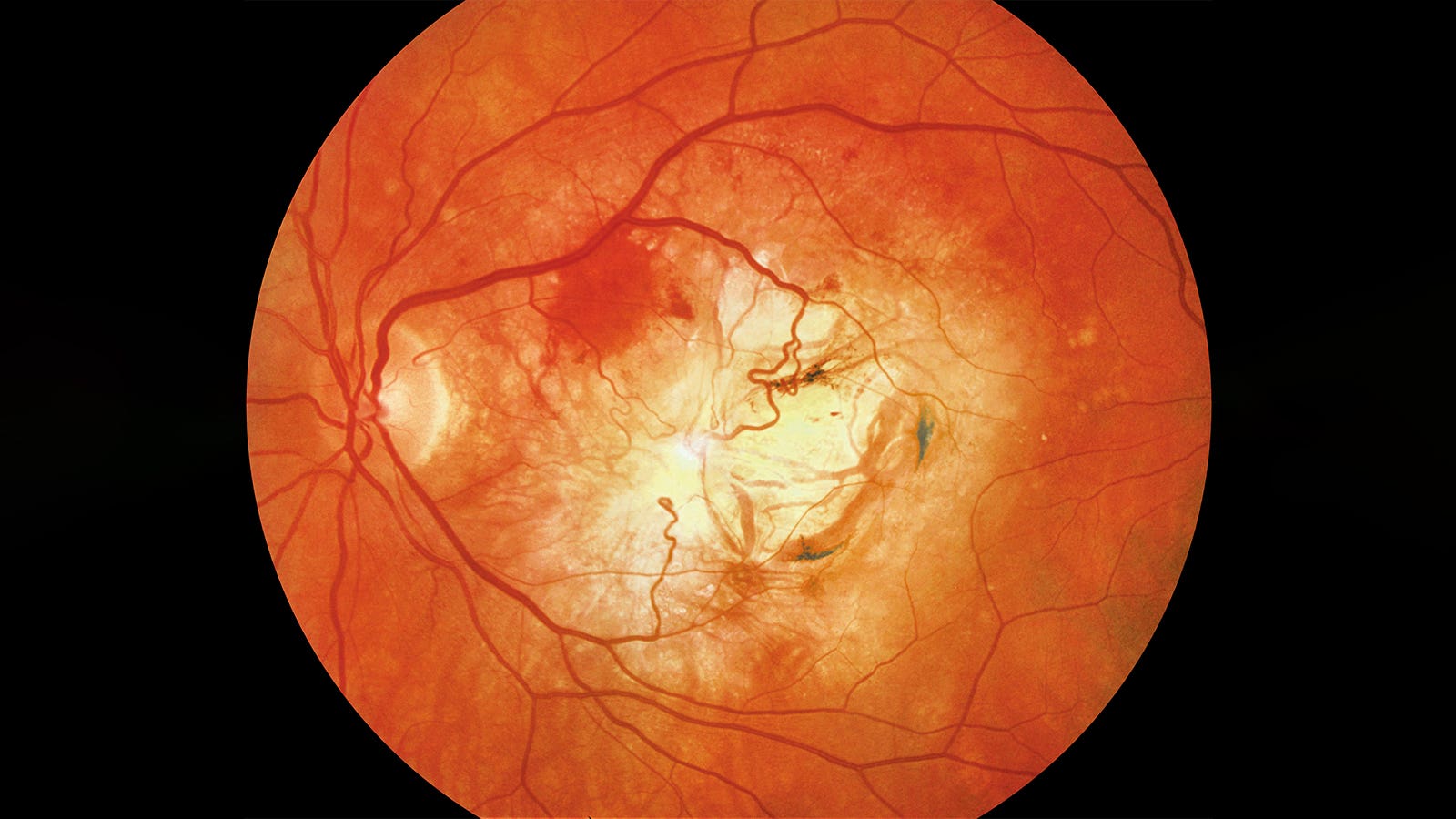 Cardiovascular risk score shows value in predicting future eye disease
