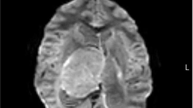 'Pray for Lace' billboards bring Abilene together for college student's ...