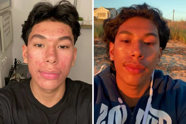 He quit weed and says his skin changed dramatically