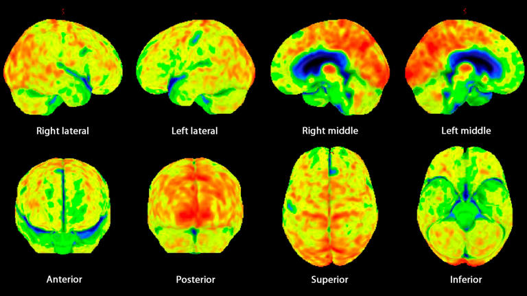 Jüngster Demenz-Kranker stirbt mit nur 24 Jahren
