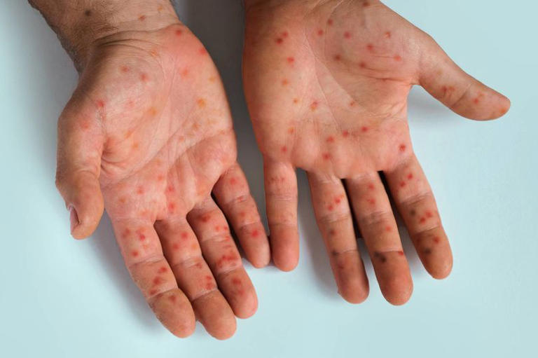 Disease X warning as four deadly viruses could spark deadly 2026 pandemic